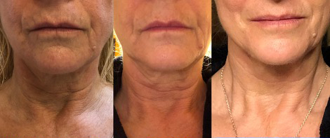 Ascent – X39 Stem Cell Activation Patches – Regenerate and Repair. The ...